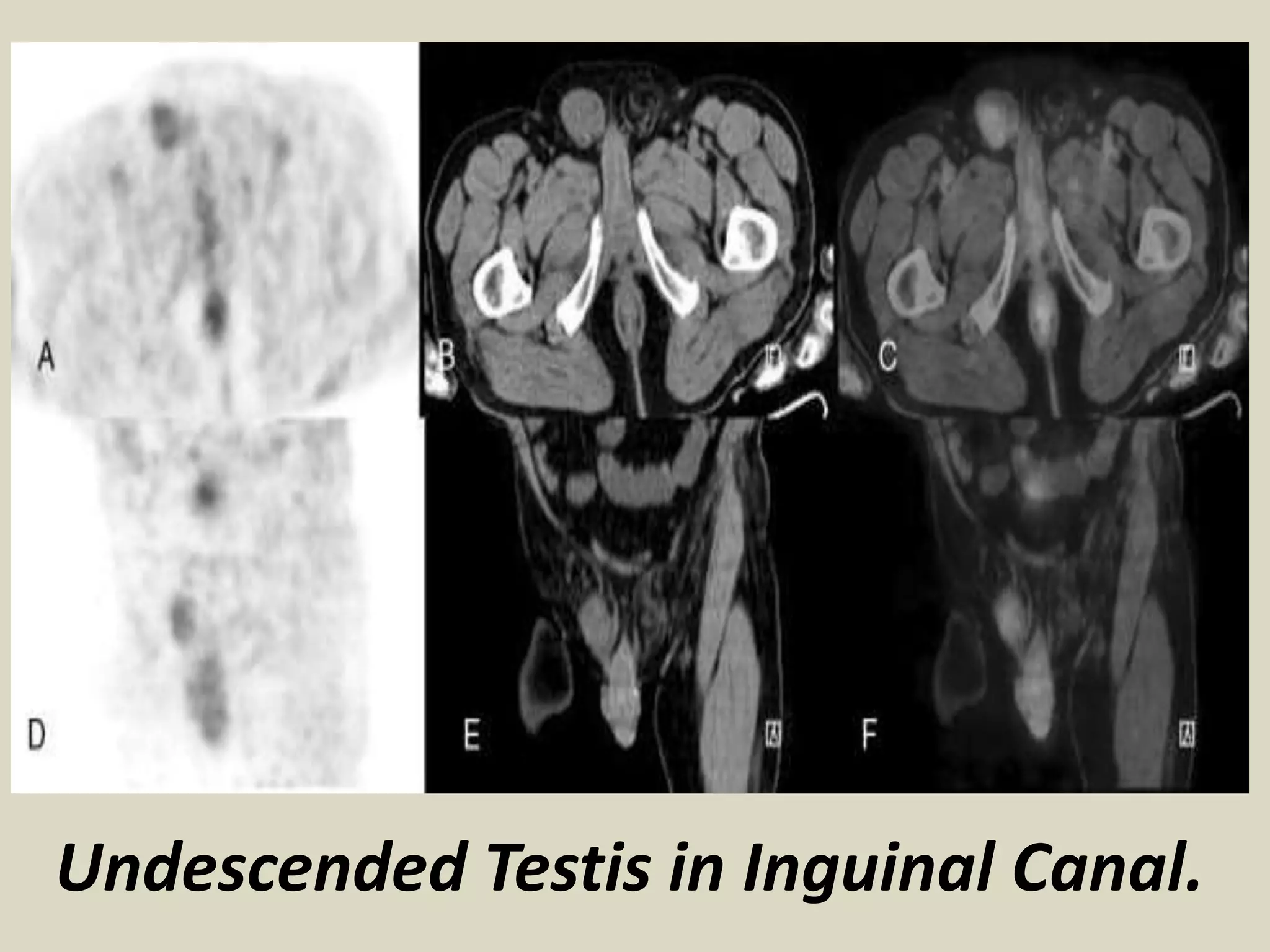 Presentation1, radiological imaging of undescended testis. | PPTX
