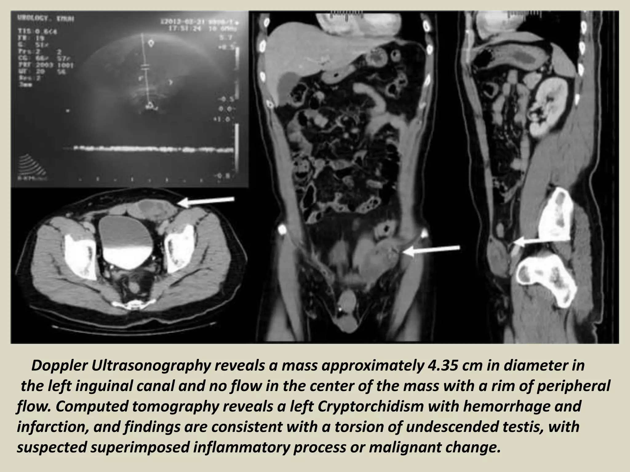 Presentation1, radiological imaging of undescended testis. | PPTX