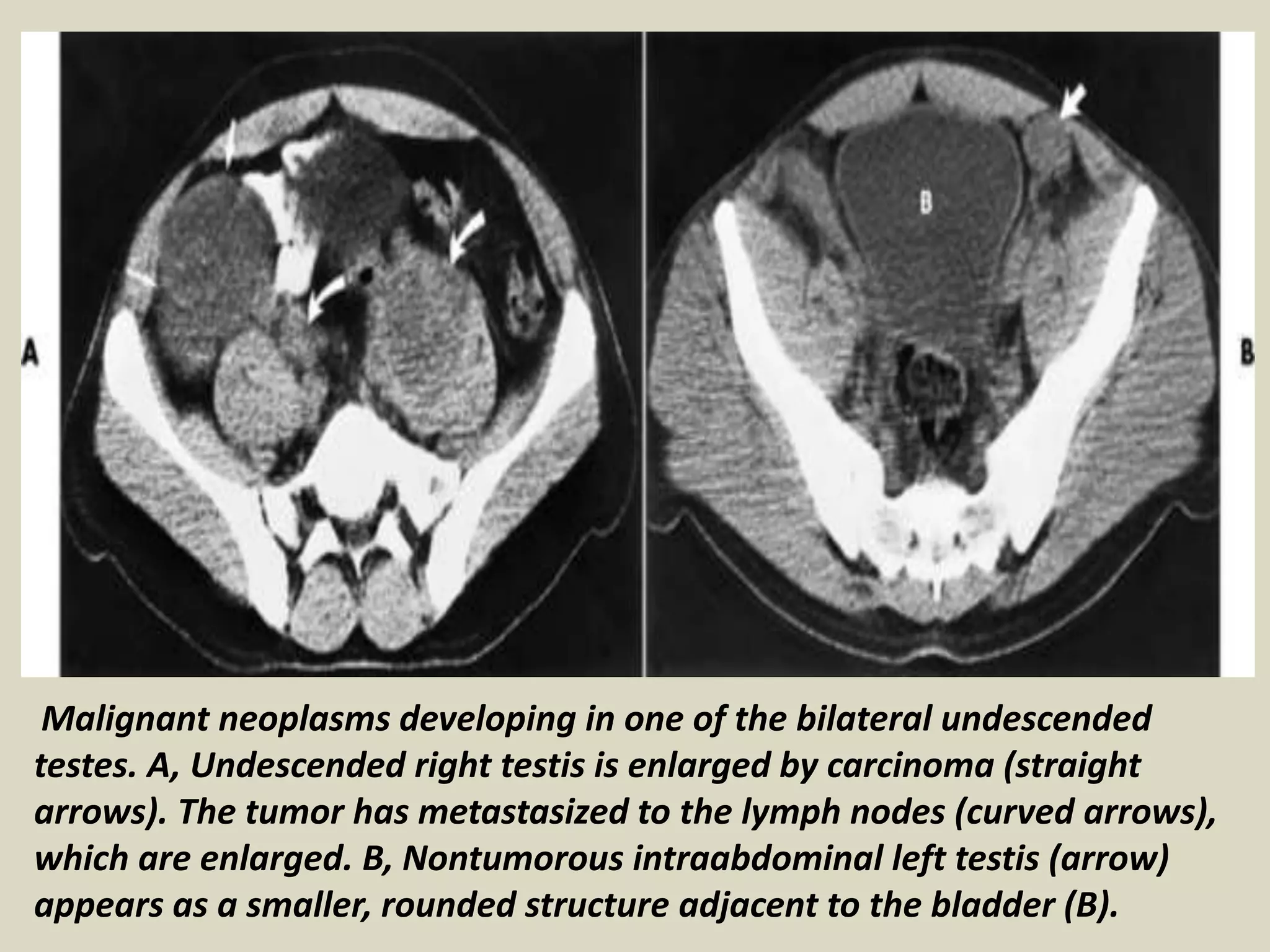 Presentation1, radiological imaging of undescended testis. | PPTX