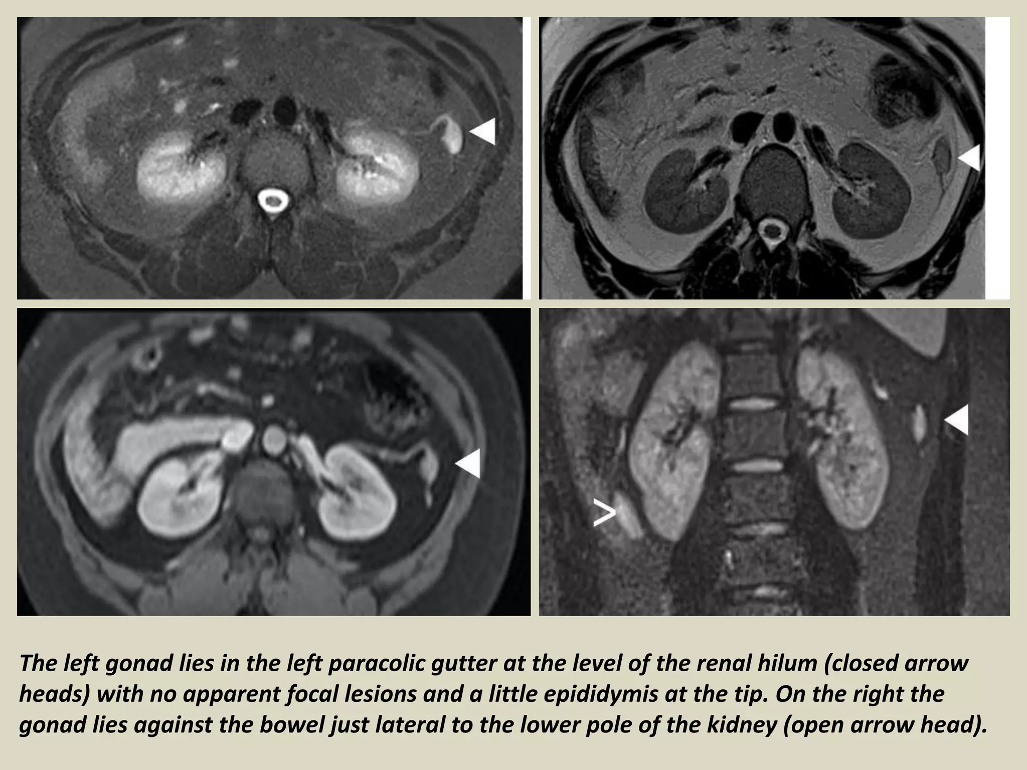 Presentation1, radiological imaging of undescended testis. | PPTX