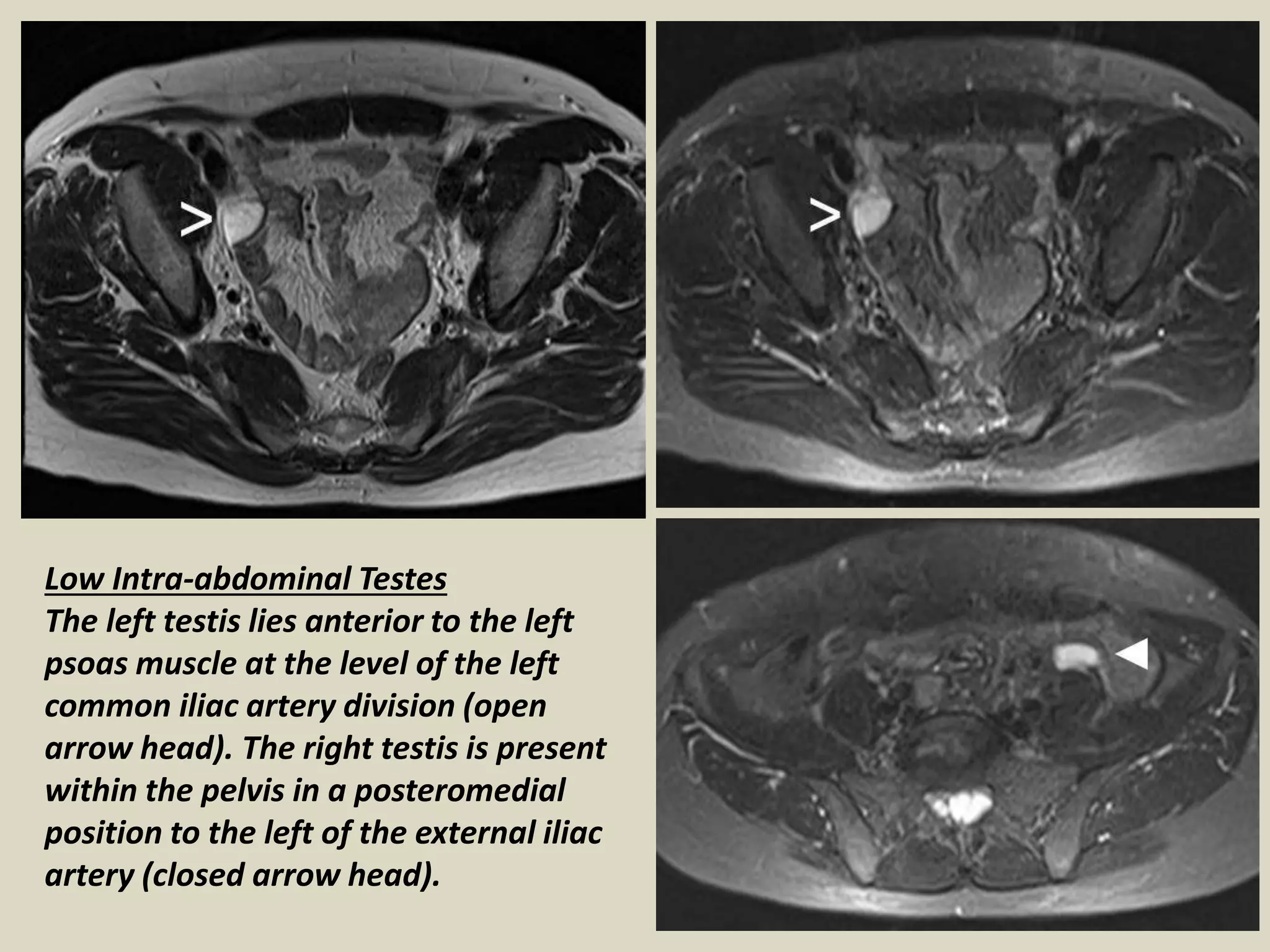 Presentation1, radiological imaging of undescended testis. | PPTX
