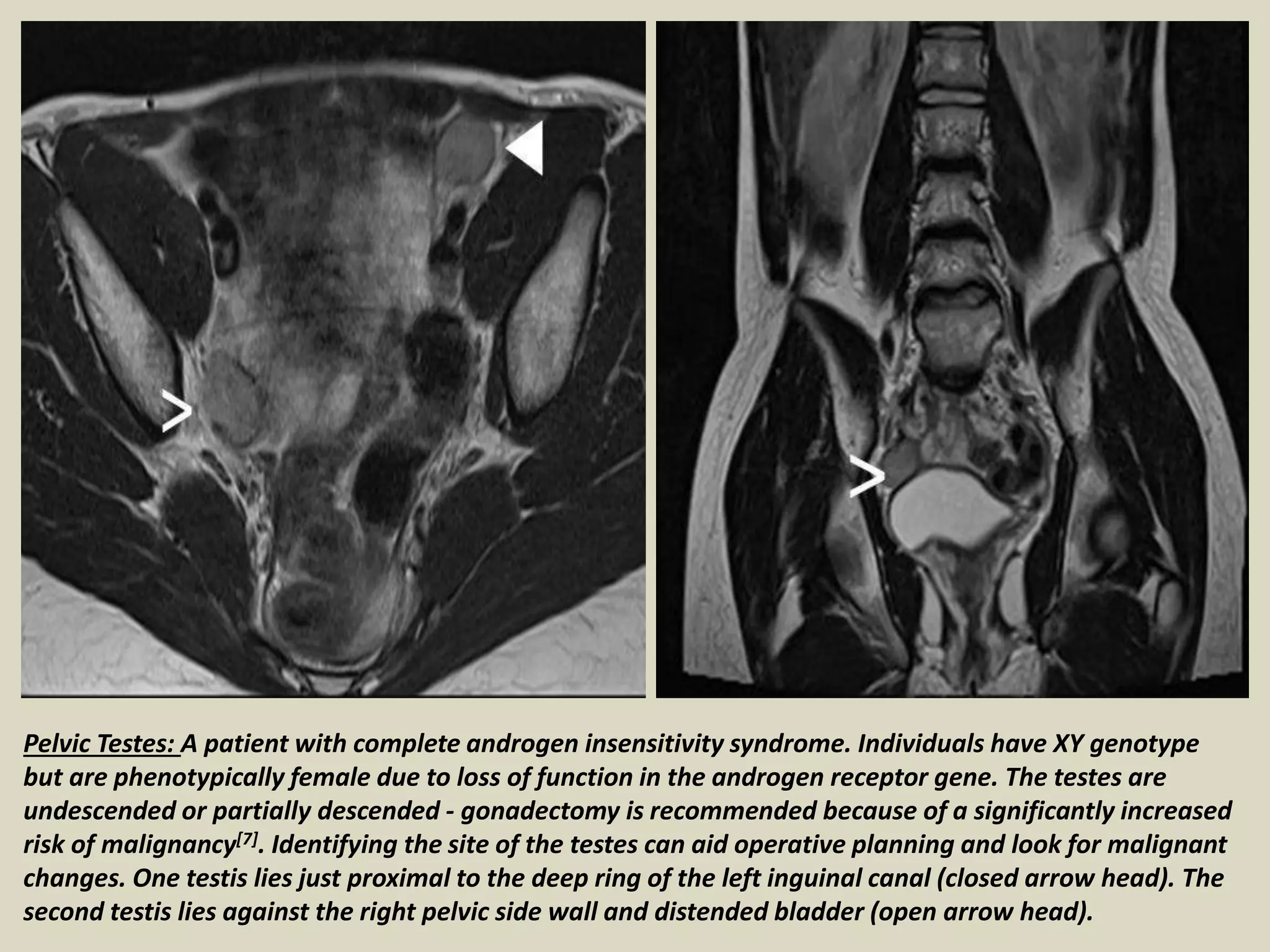 Presentation1, radiological imaging of undescended testis. | PPTX
