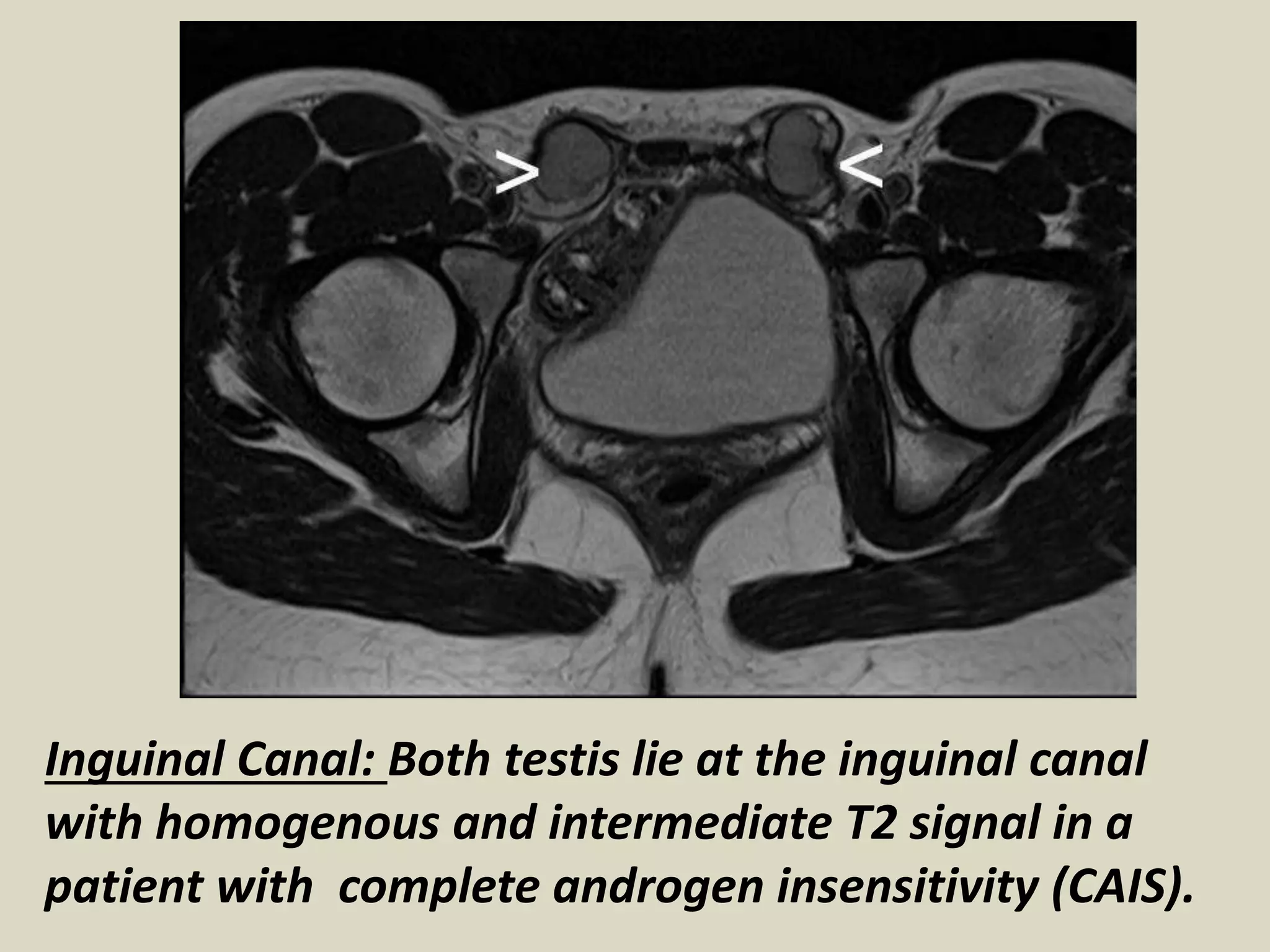Presentation1, radiological imaging of undescended testis. | PPTX