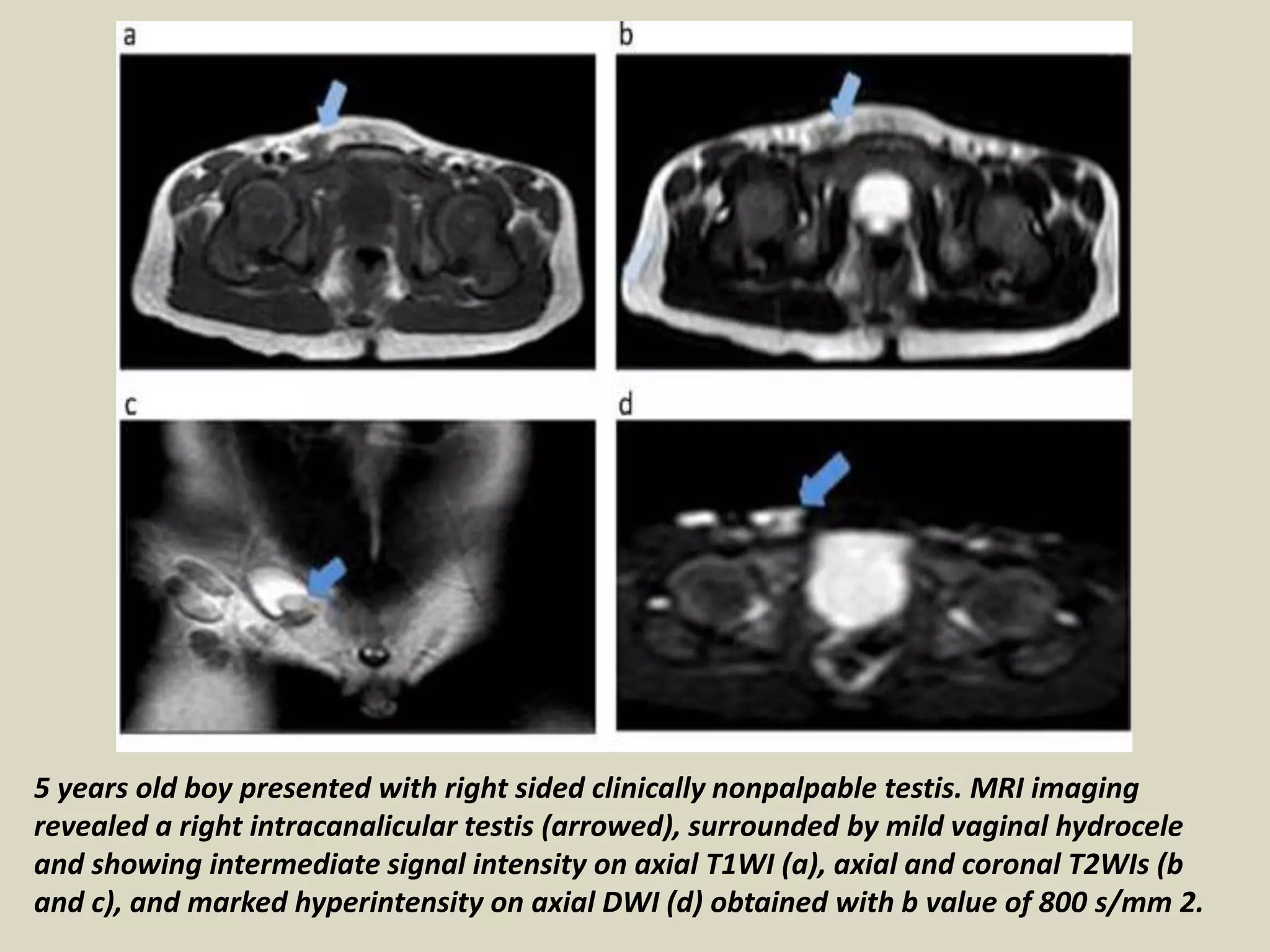 Presentation1, radiological imaging of undescended testis. | PPTX