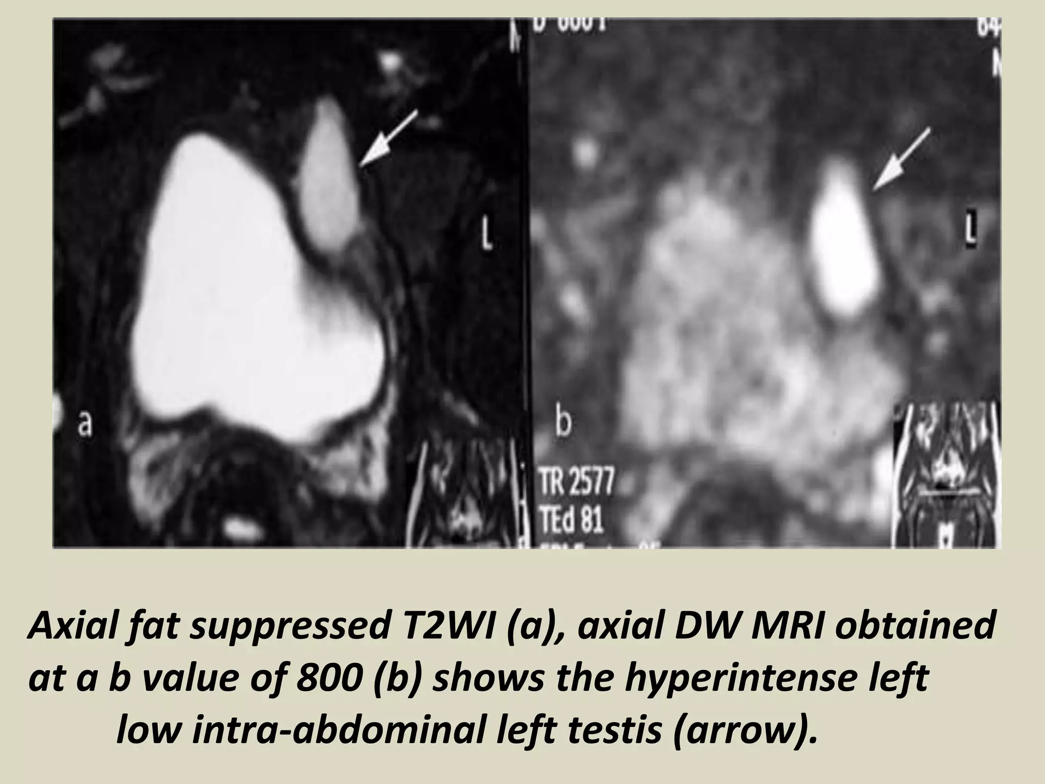 Presentation1, radiological imaging of undescended testis. | PPTX