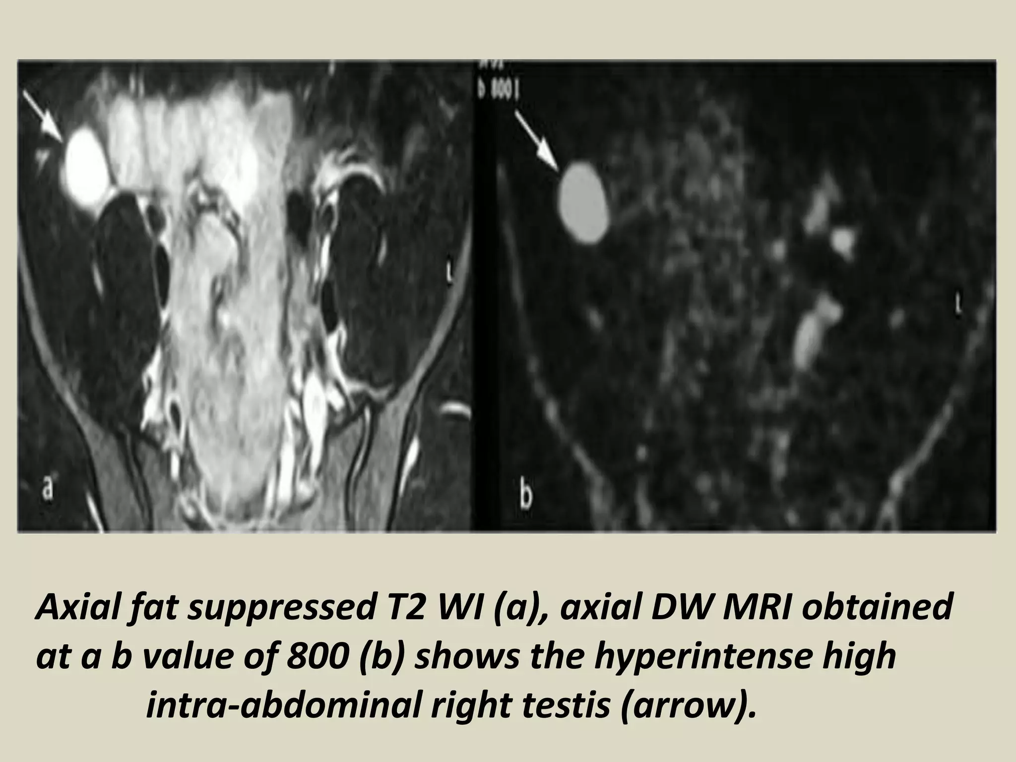 Presentation1, radiological imaging of undescended testis. | PPTX