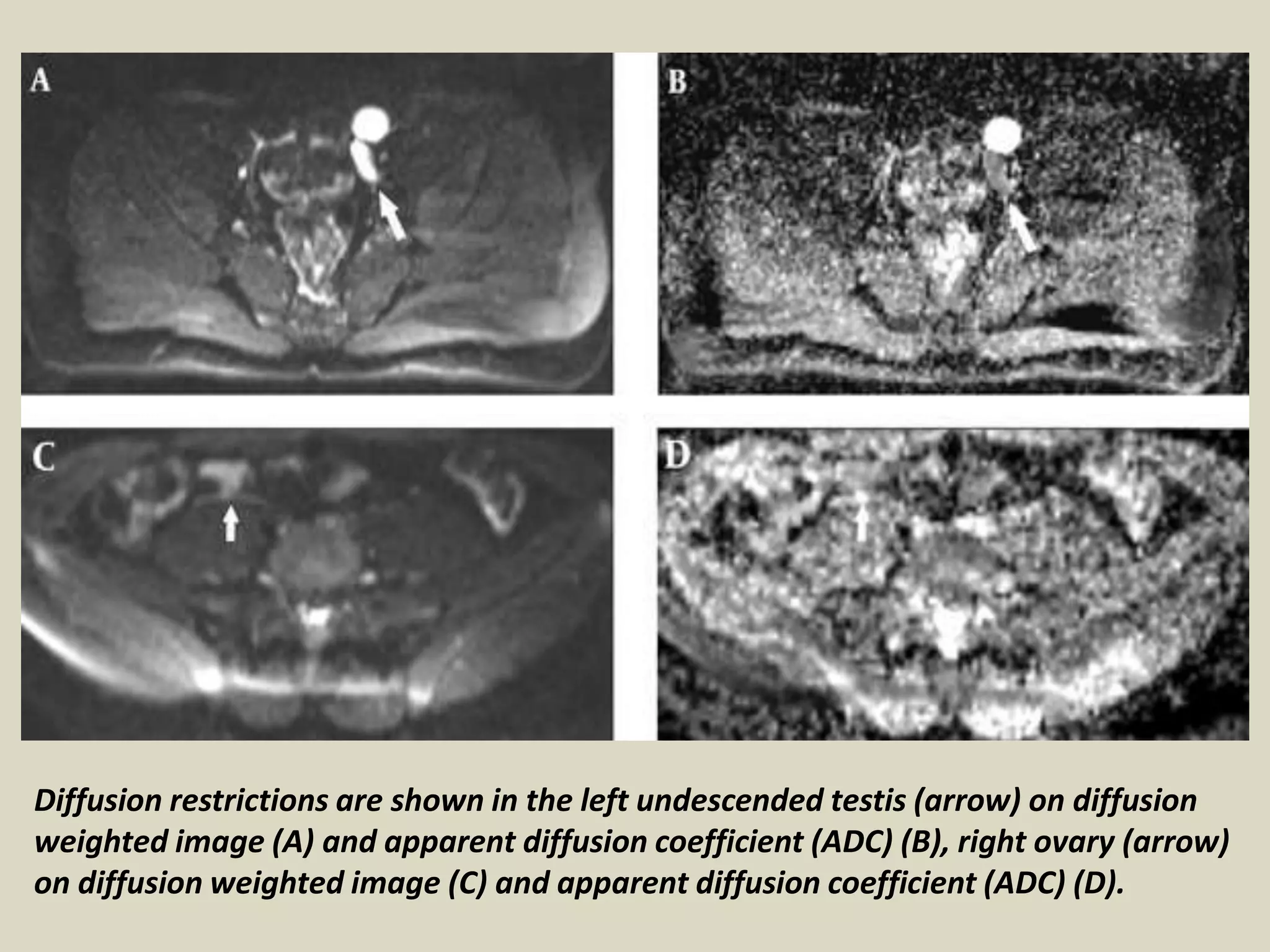 Presentation1, radiological imaging of undescended testis. | PPTX