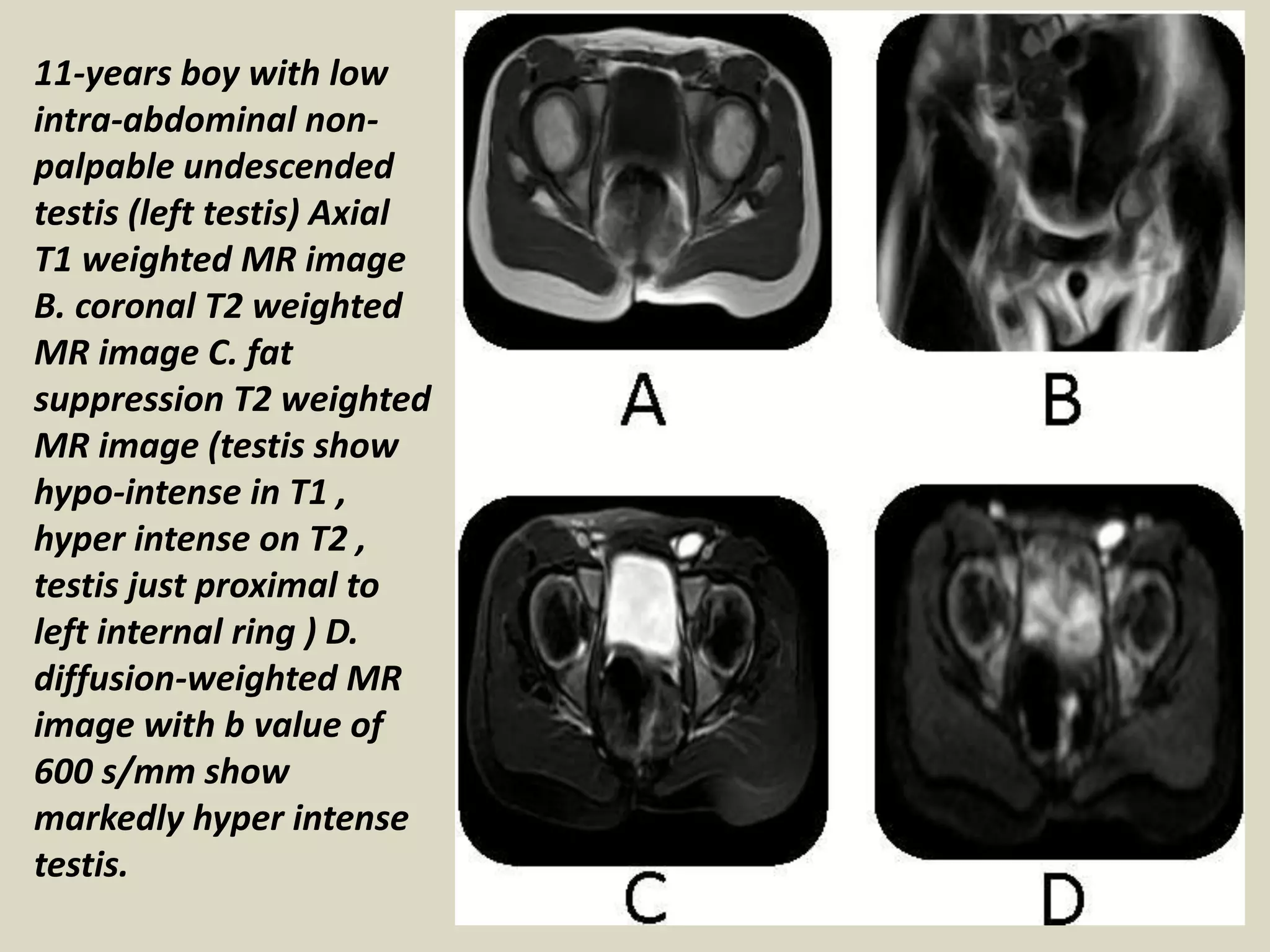 Presentation1, radiological imaging of undescended testis. | PPTX
