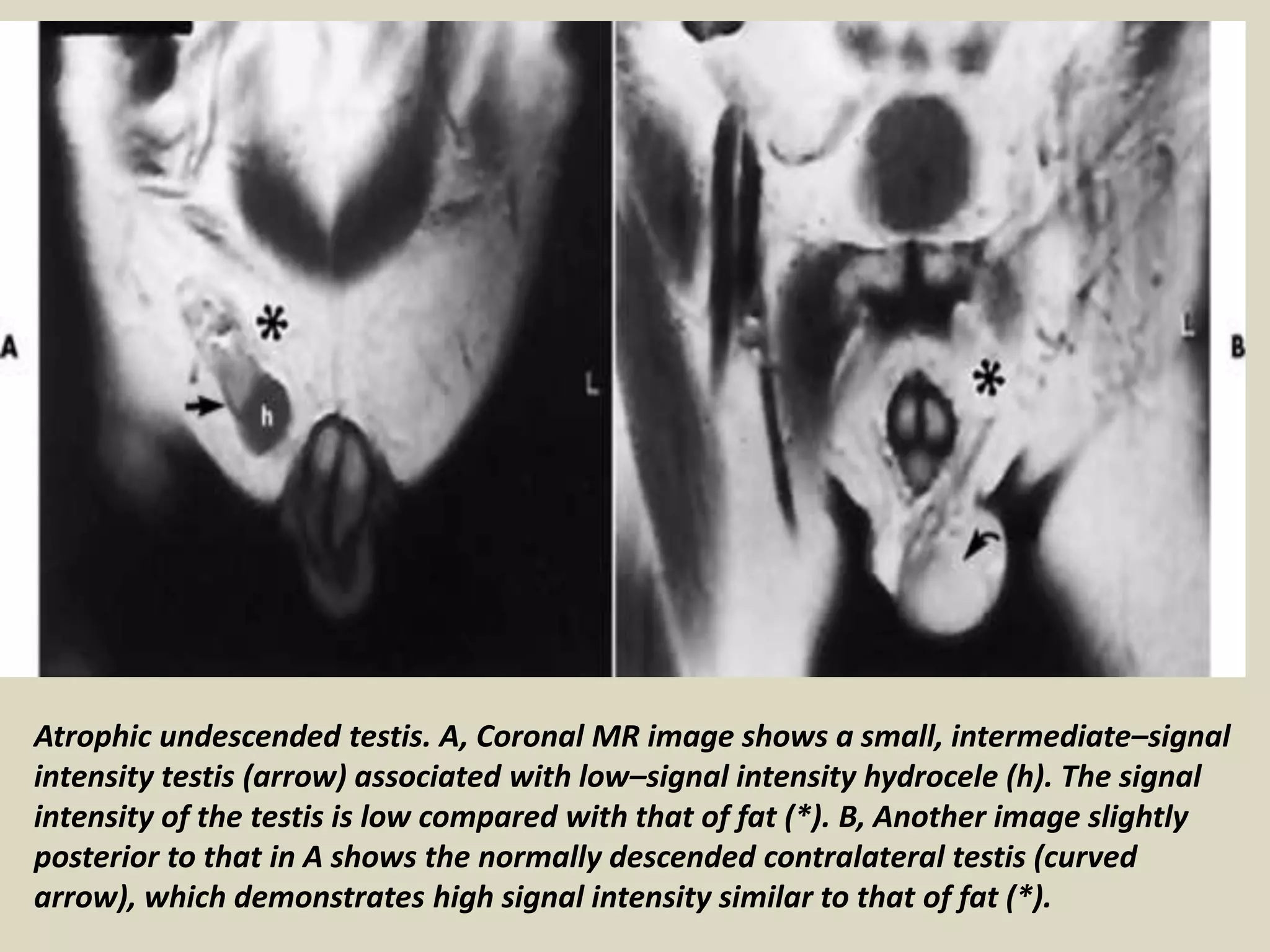 Presentation1, radiological imaging of undescended testis. | PPTX
