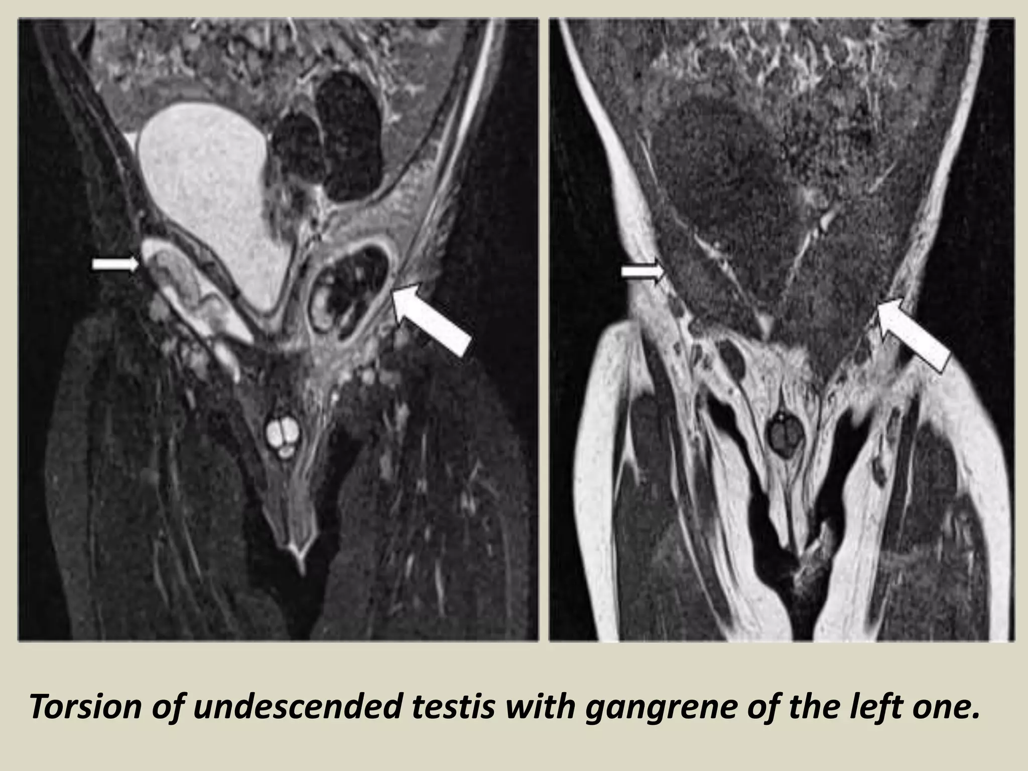Presentation1, radiological imaging of undescended testis. | PPTX