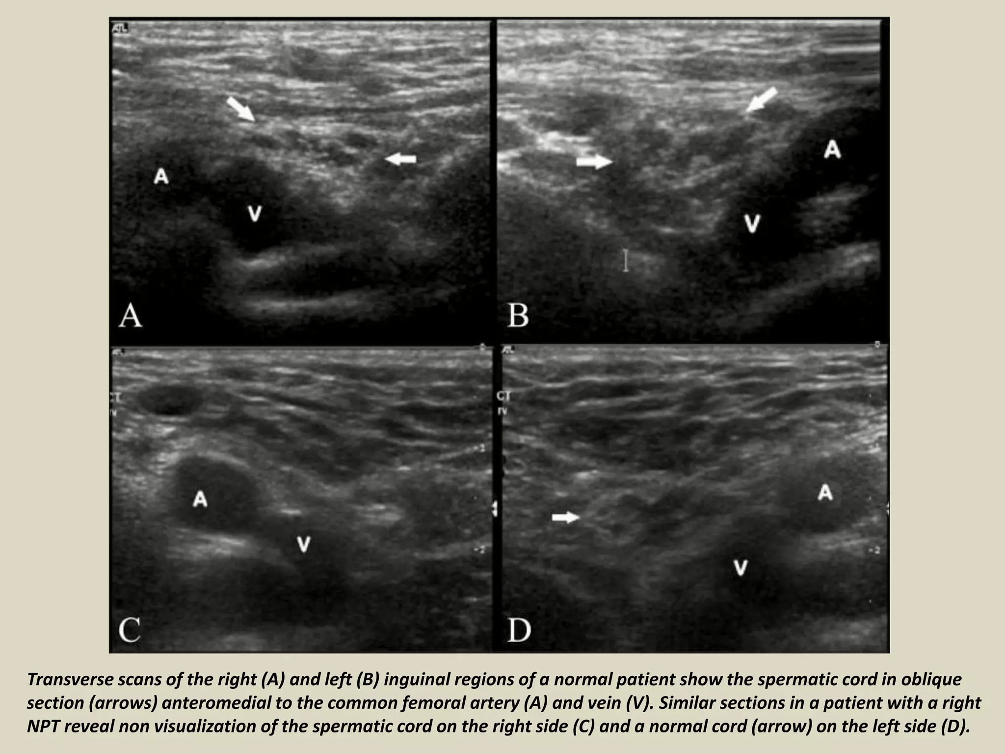 Presentation1, radiological imaging of undescended testis. | PPTX
