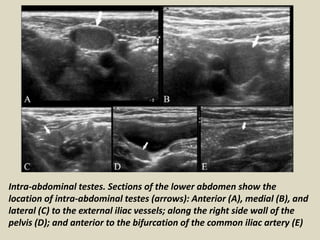 Presentation1, radiological imaging of undescended testis. | PPTX