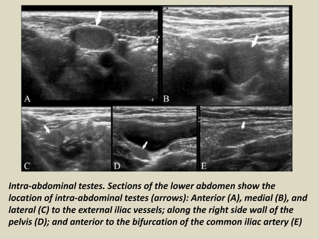 Presentation1, radiological imaging of undescended testis. | PPTX ...