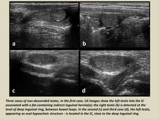 Presentation1, radiological imaging of undescended testis. | PPTX