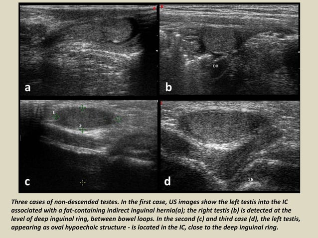 Presentation1, radiological imaging of undescended testis. | PPTX ...