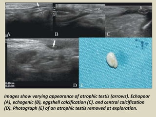 Presentation1, radiological imaging of undescended testis. | PPTX