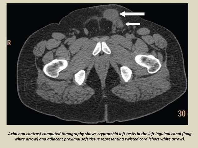 Presentation1, radiological imaging of undescended testis. | PPTX ...