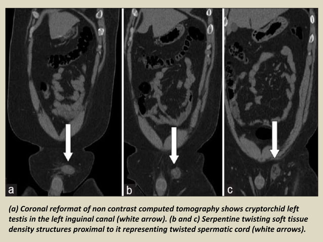 Presentation1, radiological imaging of undescended testis. | PPTX ...