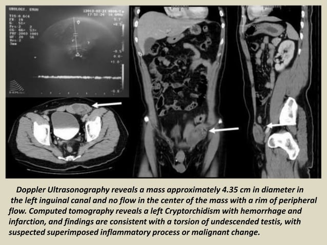 Presentation1, radiological imaging of undescended testis. | PPTX ...