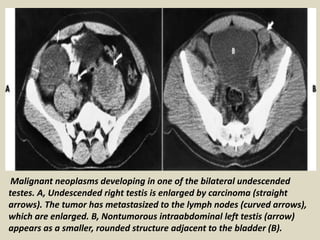 Presentation1, radiological imaging of undescended testis. | PPTX