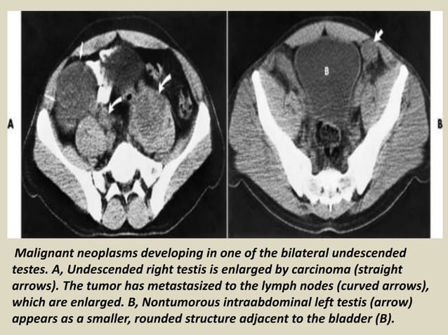 Presentation1, radiological imaging of undescended testis. | PPTX ...