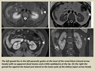 Presentation1, radiological imaging of undescended testis. | PPTX