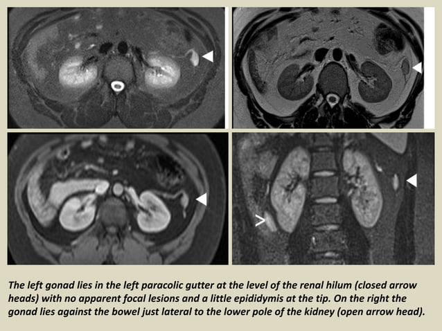 Presentation1, radiological imaging of undescended testis. | PPTX ...