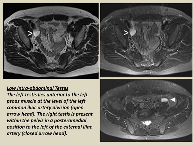 Presentation1, radiological imaging of undescended testis. | PPTX ...