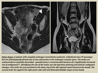 Presentation1, radiological imaging of undescended testis. | PPTX