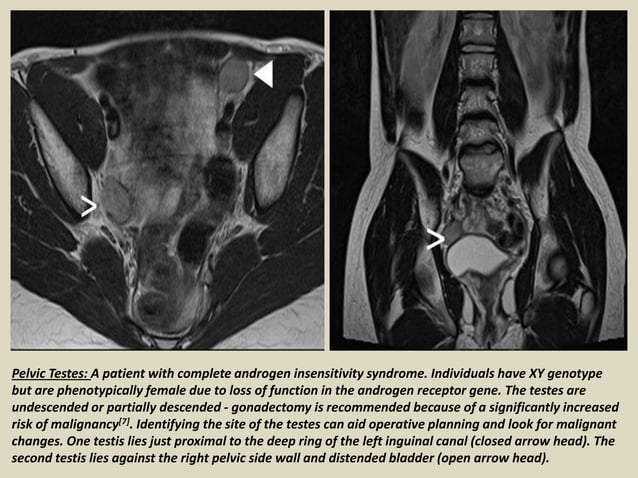 Presentation1, radiological imaging of undescended testis. | PPTX ...