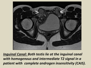 Presentation1, radiological imaging of undescended testis. | PPTX