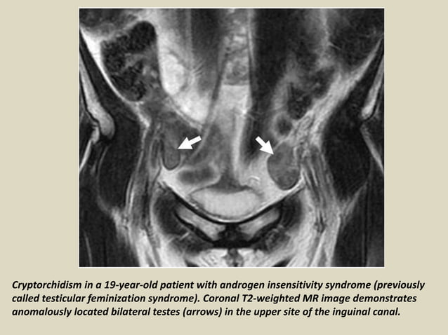 Presentation1, radiological imaging of undescended testis. | PPTX ...