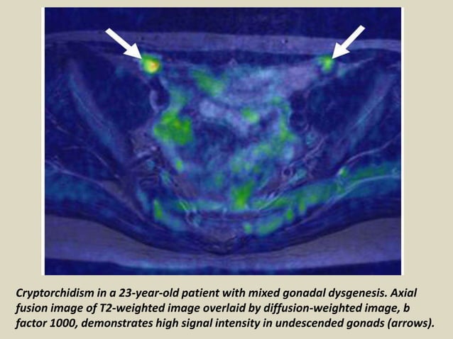 Presentation1 Radiological Imaging Of Undescended Testis Ppt