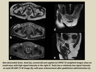 Presentation1, radiological imaging of undescended testis. | PPTX