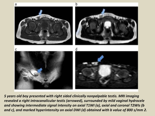 Presentation1, radiological imaging of undescended testis. | PPTX ...