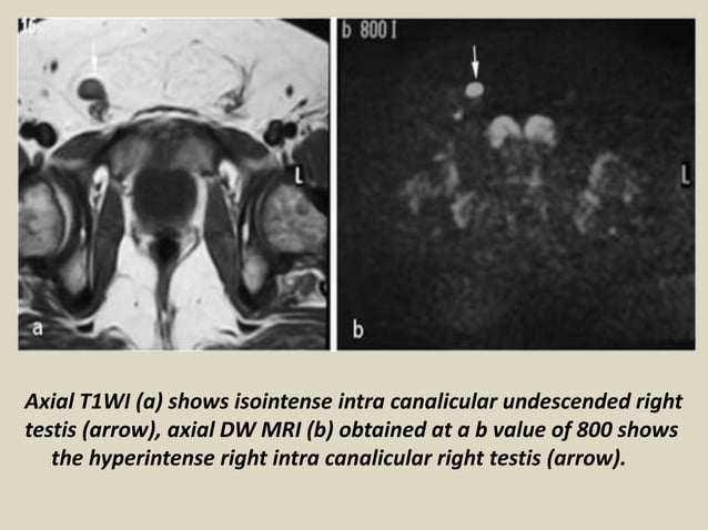 Presentation1, radiological imaging of undescended testis. | PPTX ...