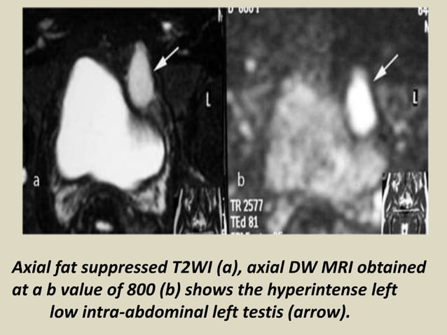 Presentation1, radiological imaging of undescended testis. | PPTX ...
