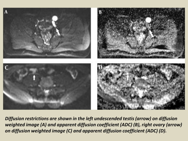 Presentation1, radiological imaging of undescended testis. | PPTX ...