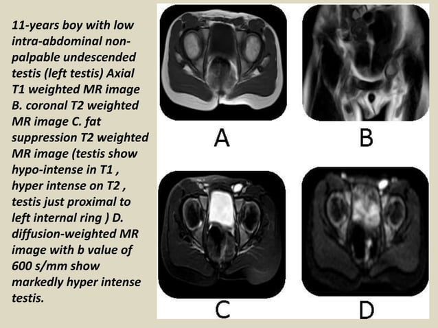 Presentation1, radiological imaging of undescended testis. | PPTX ...