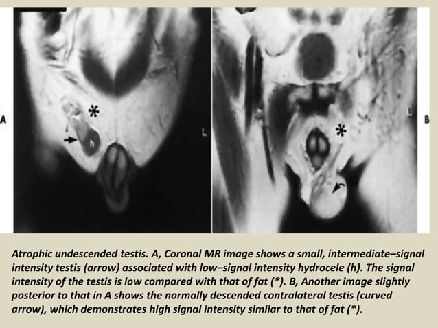 Presentation1, radiological imaging of undescended testis. | PPTX ...