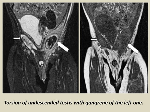 Presentation1, radiological imaging of undescended testis. | PPTX ...