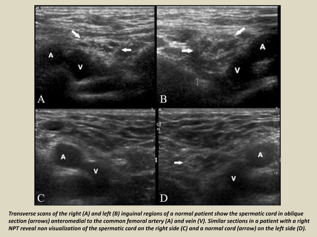 Presentation1, radiological imaging of undescended testis. | PPTX ...