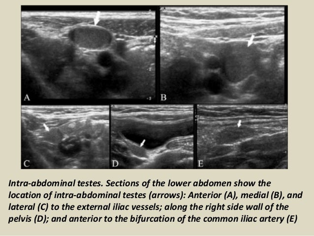 Presentation1, radiological imaging of undescended testis.