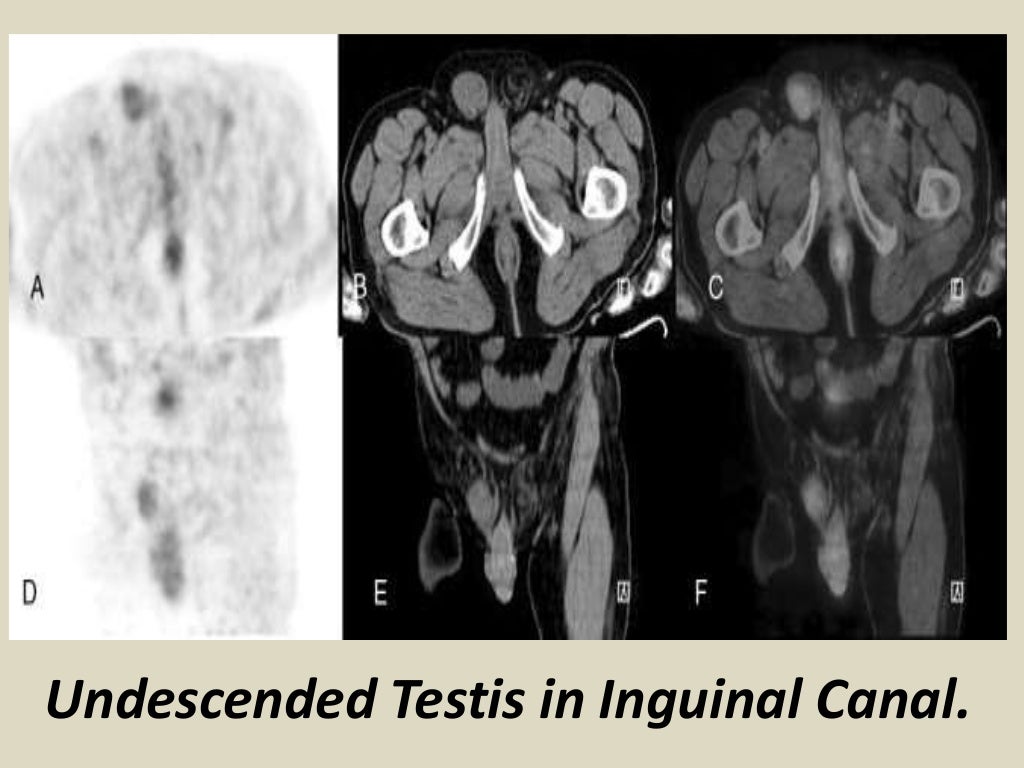 Presentation1, radiological imaging of undescended testis.