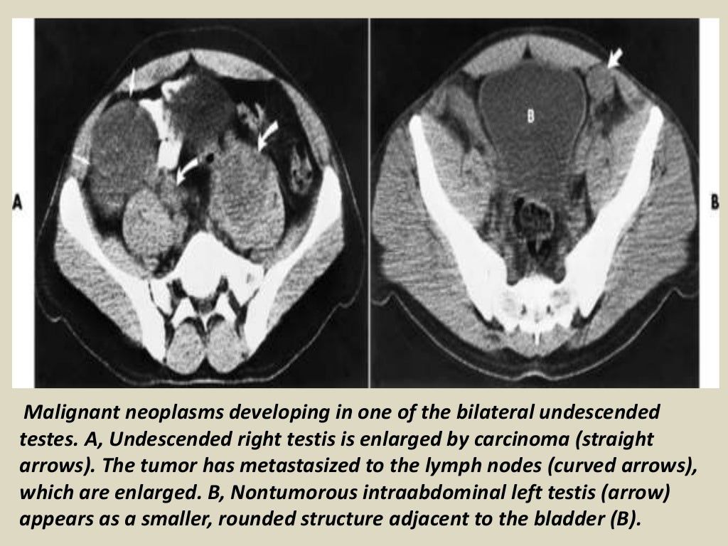 Presentation1, radiological imaging of undescended testis.