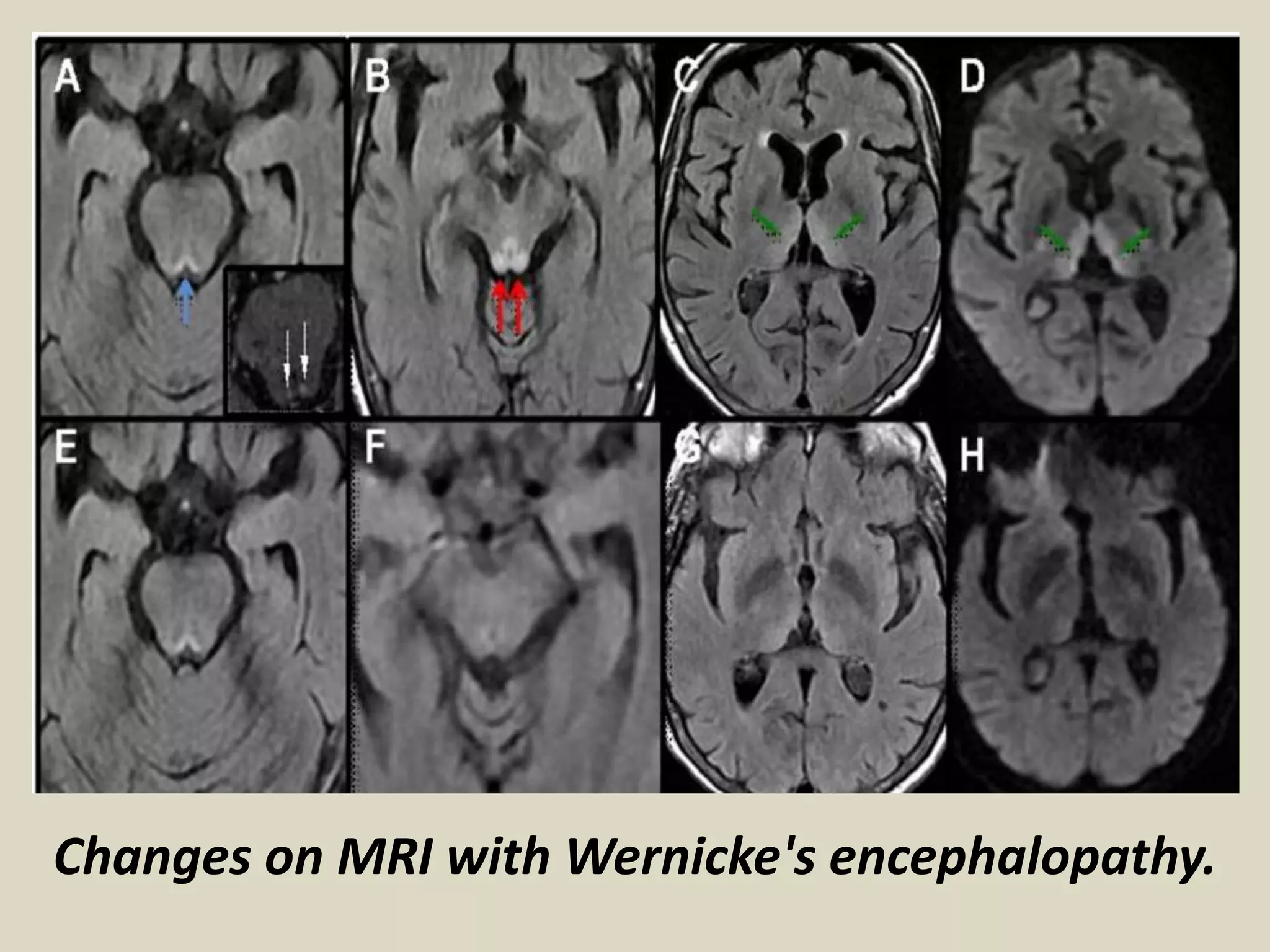 Presentation1, radiological imaging of wernicke encephalopathy. | PPTX