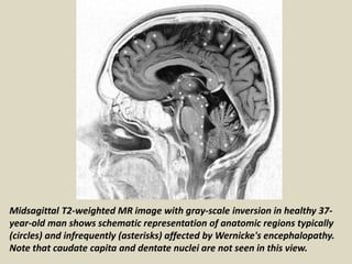 Presentation1, radiological imaging of wernicke encephalopathy. | PPTX