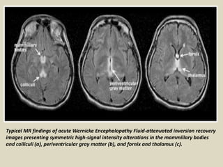 Mammillary Bodies Mri