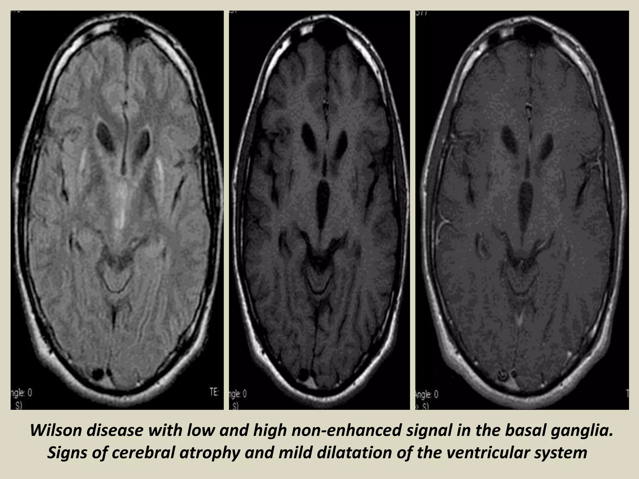 Presentation1, radiological imaging of wilson disease. | PPTX