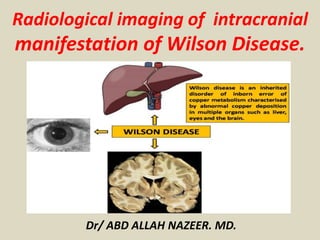 Presentation1, radiological imaging of wilson disease. | PPTX